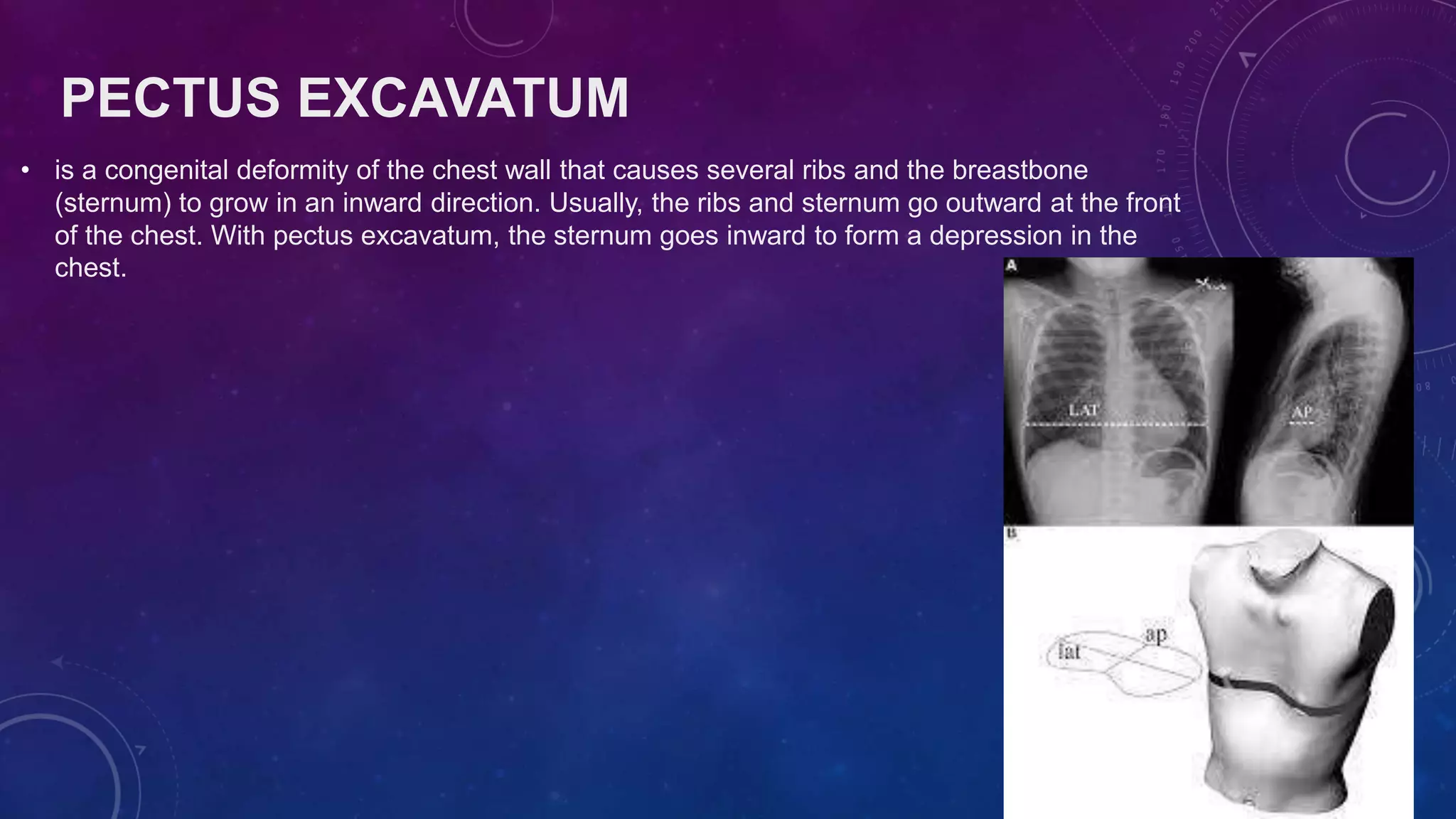 X-ray images of lung diseases (pneumonia, tuberculosis, and tumors)..pptx