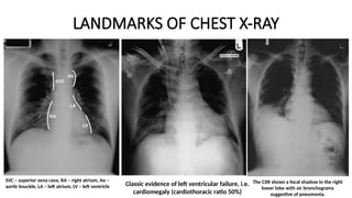 X-Ray Imaging Technique and Interpretation for Physiotherapists.pptx