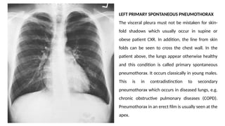 X-Ray Imaging Technique and Interpretation for Physiotherapists.pptx