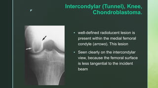 Intercondylar Notch View