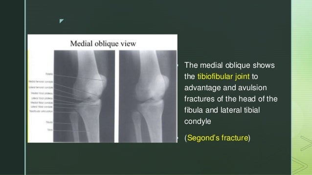 Medial Oblique Knee X Ray