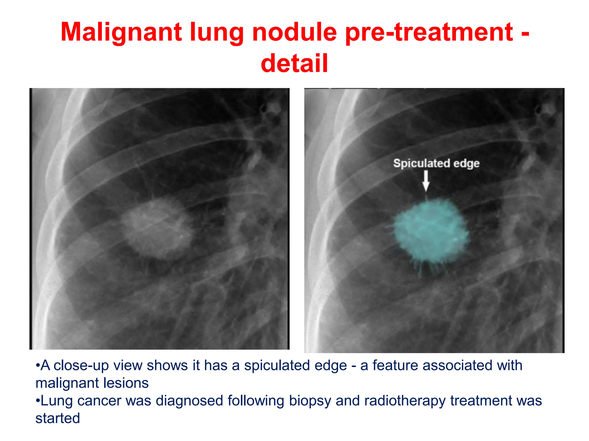 CHEST X-RAYS OF LUNGCANCER.........pptx