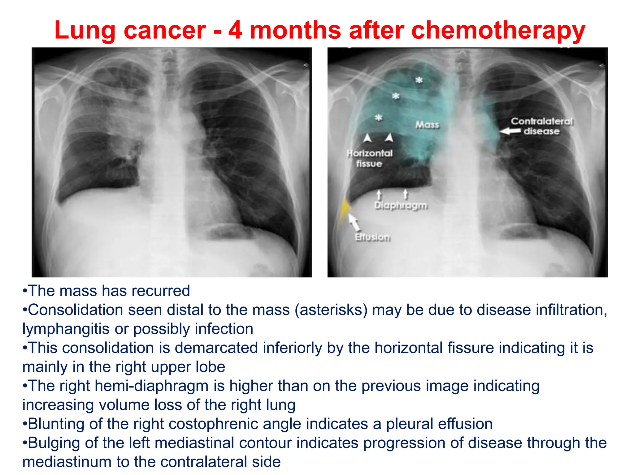 CHEST X-RAYS OF LUNGCANCER.........pptx