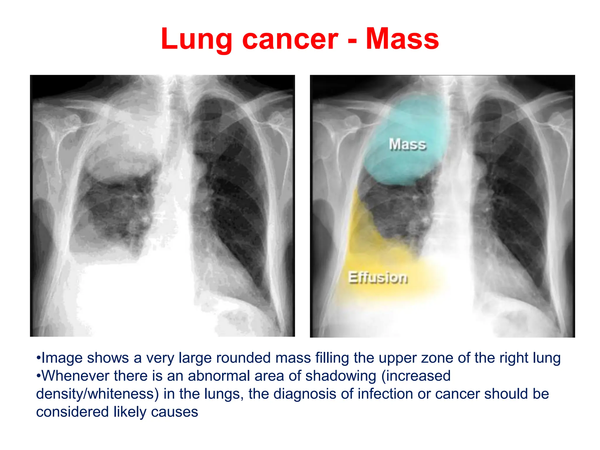 CHEST X-RAYS OF LUNGCANCER.........pptx