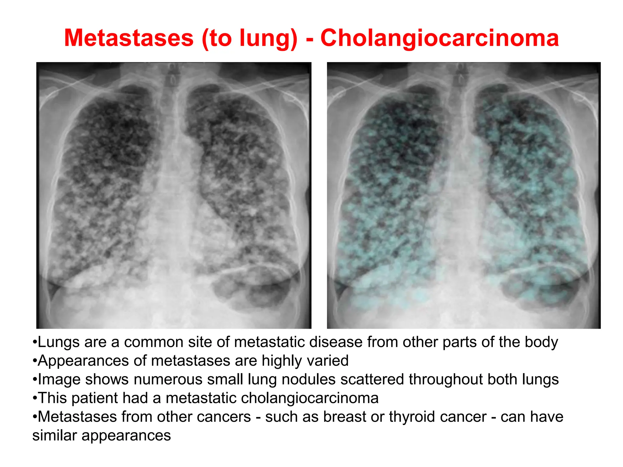 CHEST X-RAYS OF LUNGCANCER.........pptx