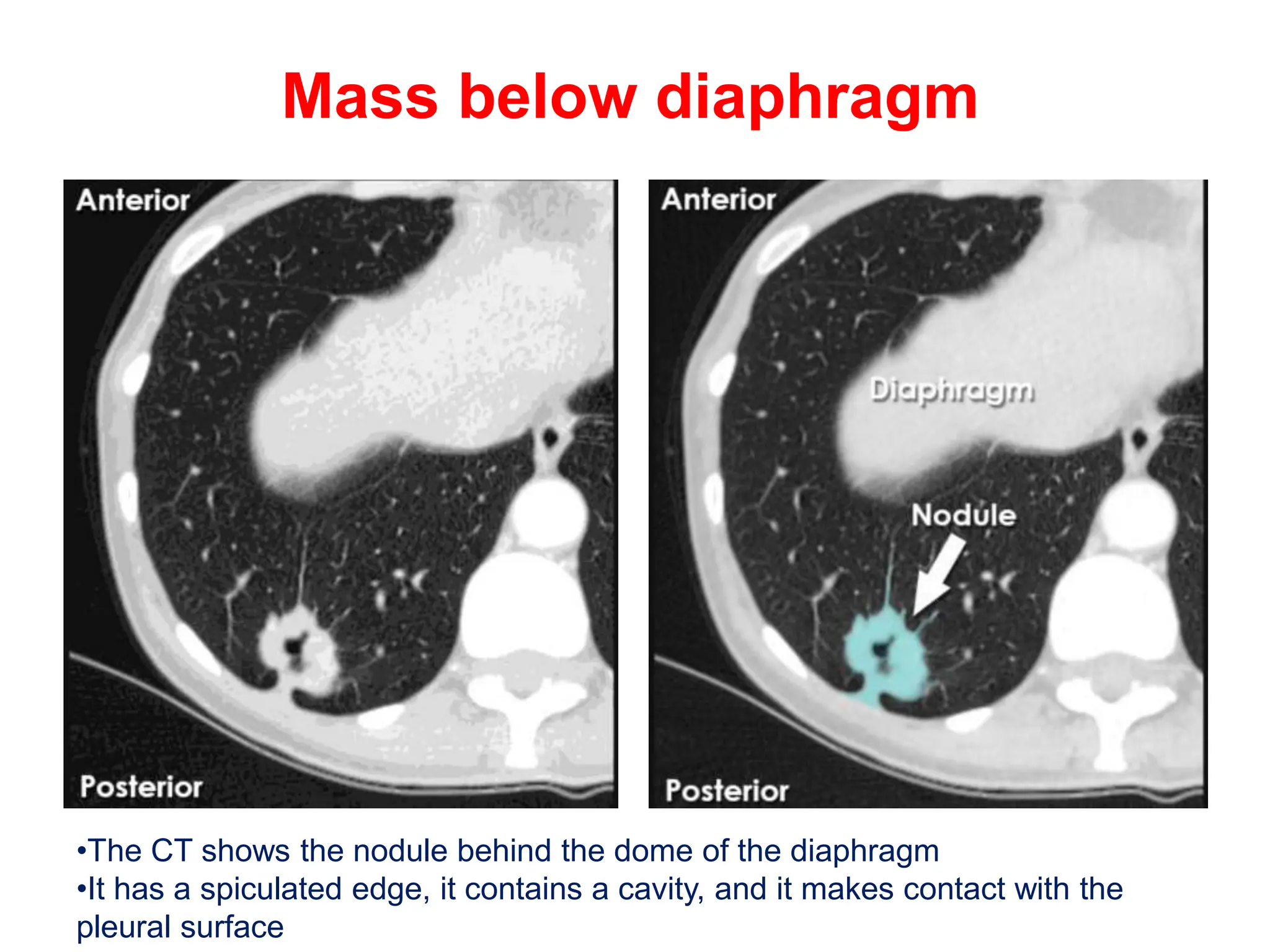 CHEST X-RAYS OF LUNGCANCER.........pptx
