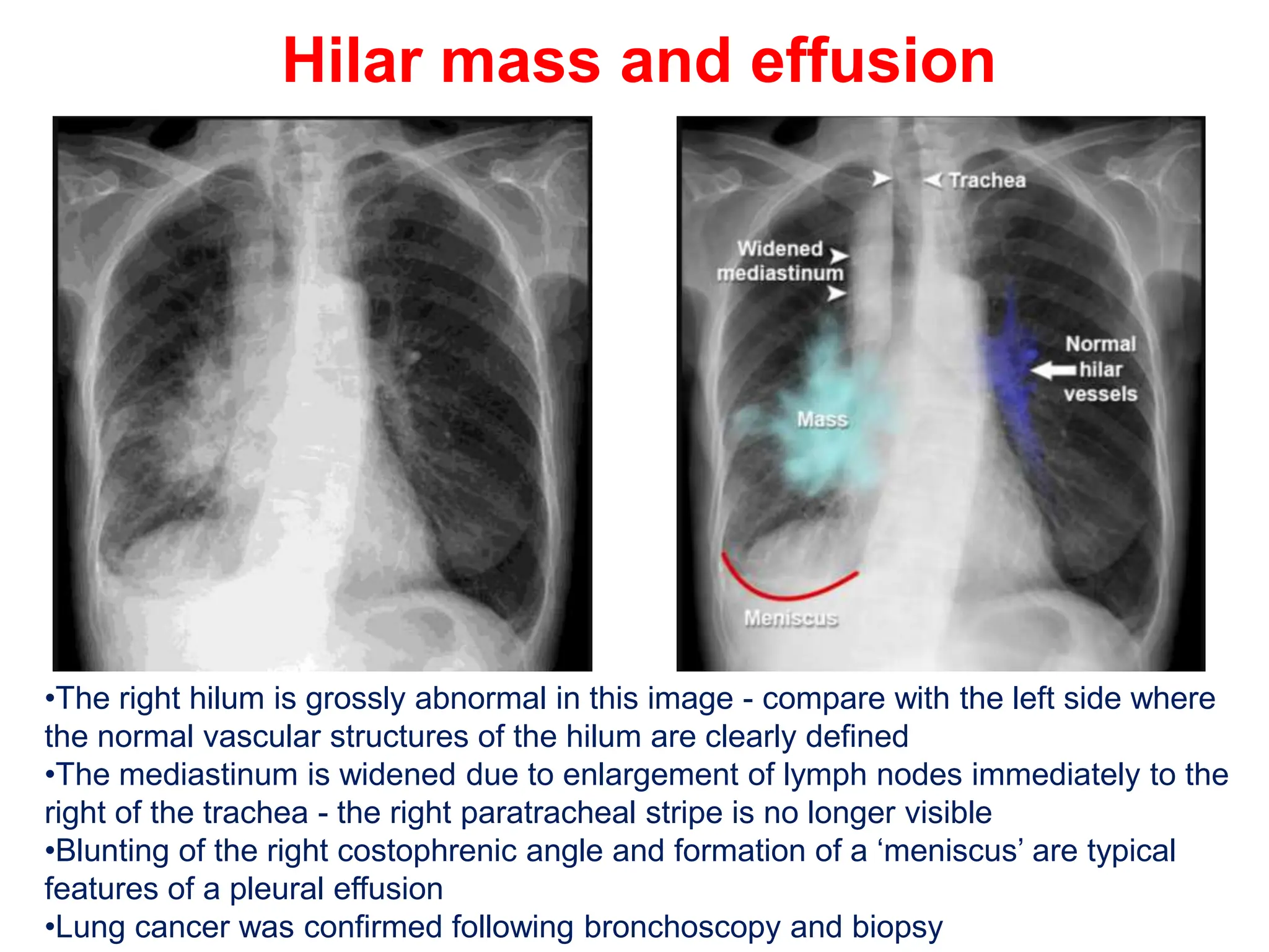 CHEST X-RAYS OF LUNGCANCER.........pptx
