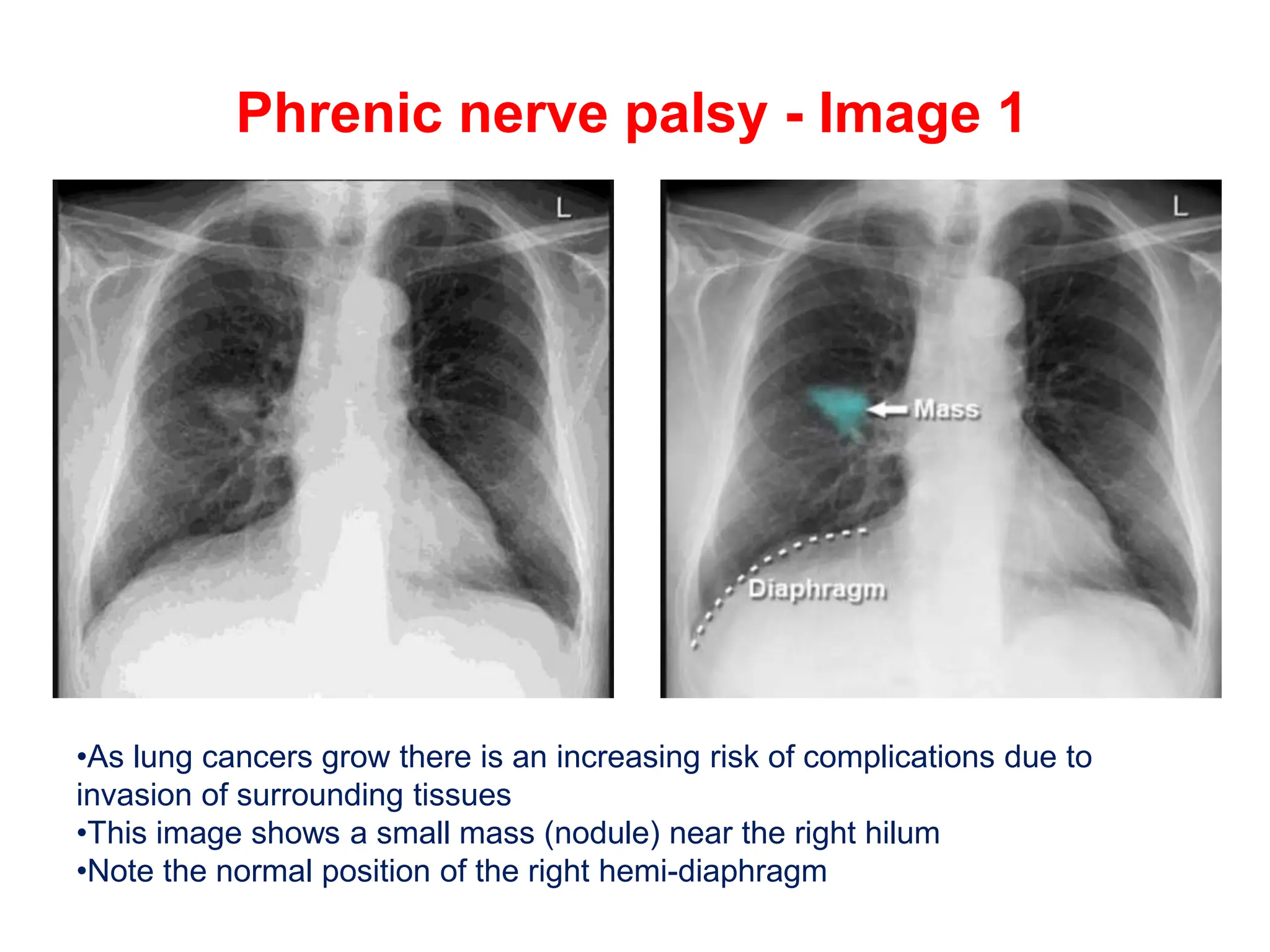 CHEST X-RAYS OF LUNGCANCER.........pptx