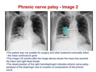 CHEST X-RAYS OF LUNGCANCER.........pptx