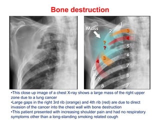CHEST X-RAYS OF LUNGCANCER.........pptx