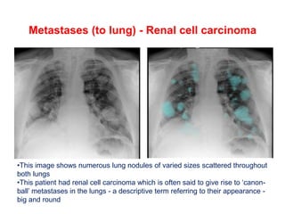 CHEST X-RAYS OF LUNGCANCER.........pptx