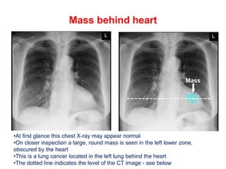CHEST X-RAYS OF LUNGCANCER.........pptx