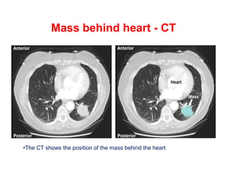 CHEST X-RAYS OF LUNGCANCER.........pptx