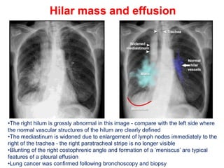 CHEST X-RAYS OF LUNGCANCER.........pptx