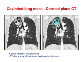 CHEST X-RAYS OF LUNGCANCER.........pptx