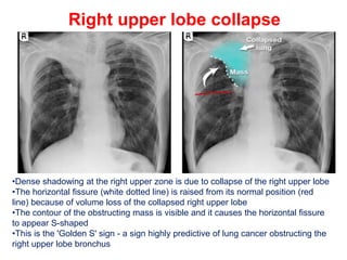 CHEST X-RAYS OF LUNGCANCER.........pptx