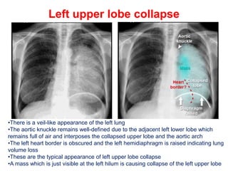 CHEST X-RAYS OF LUNGCANCER.........pptx