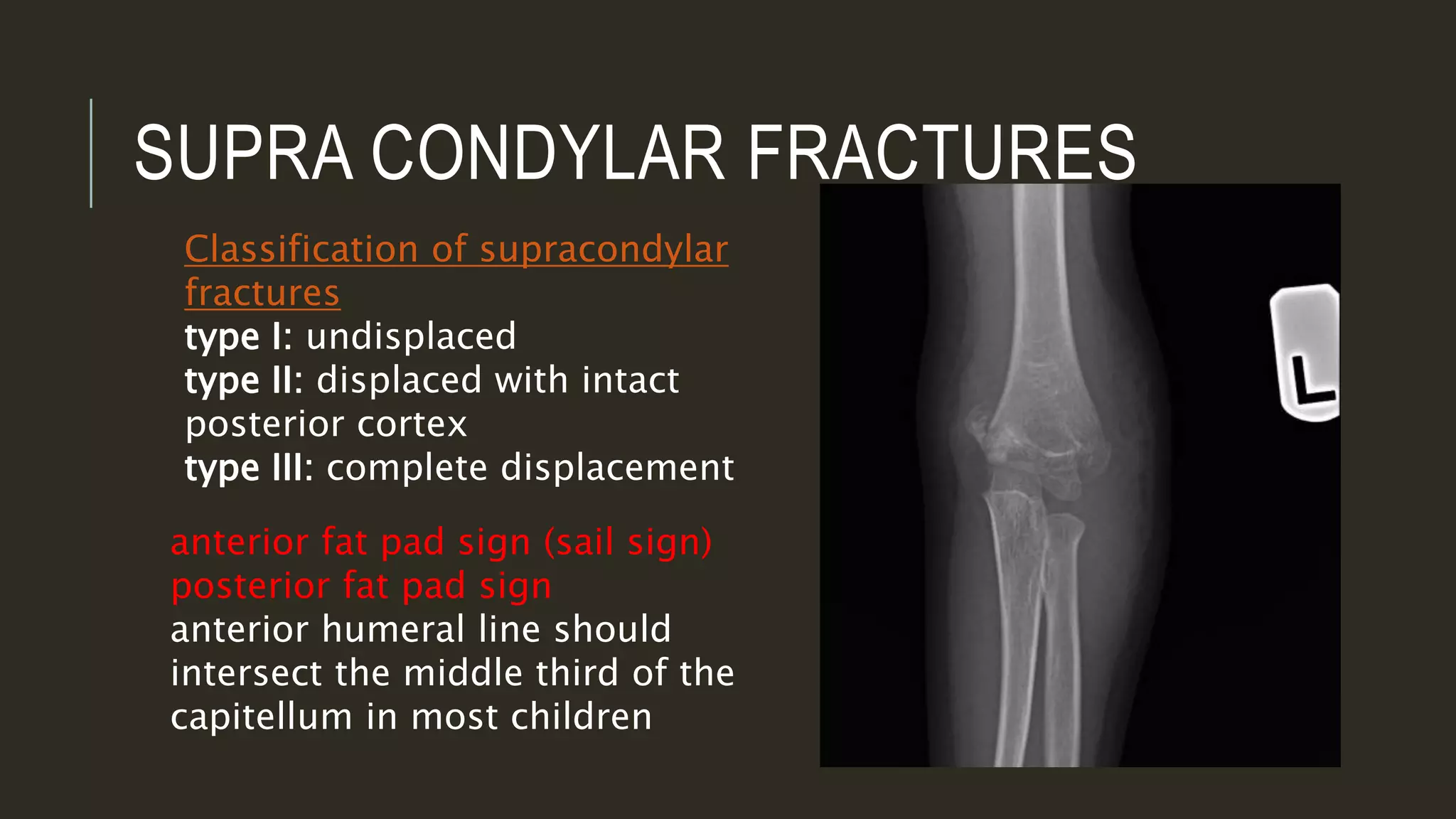 X ray of elbow joint | PPTX
