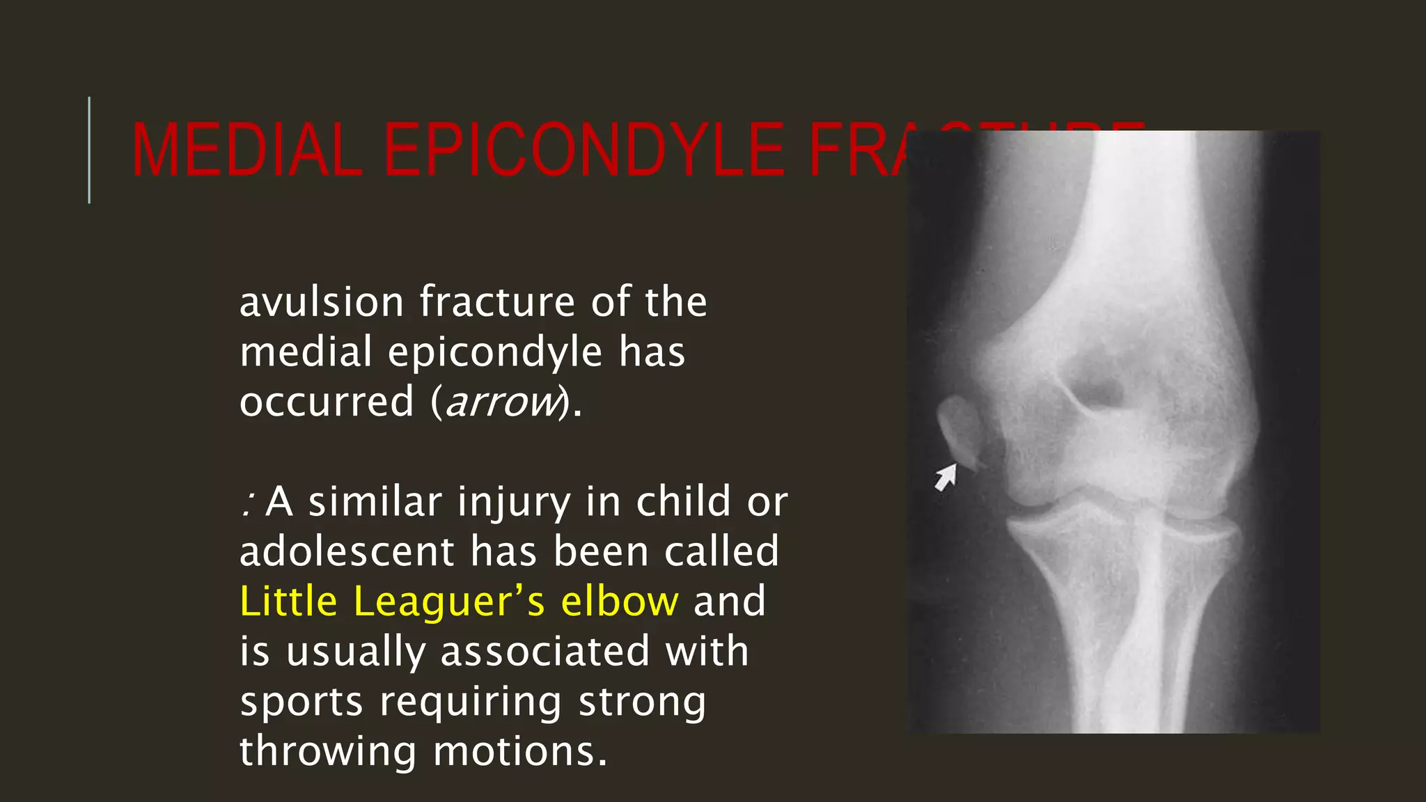 X ray of elbow joint | PPTX
