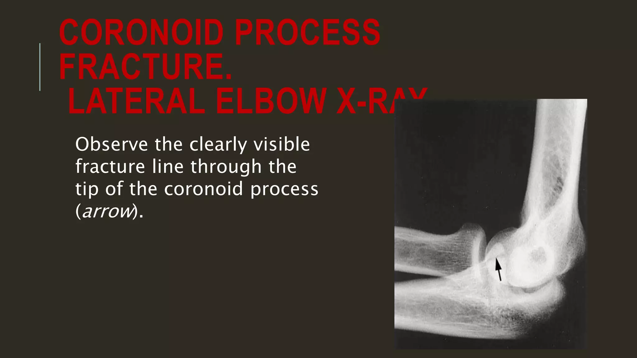 X ray of elbow joint | PPTX