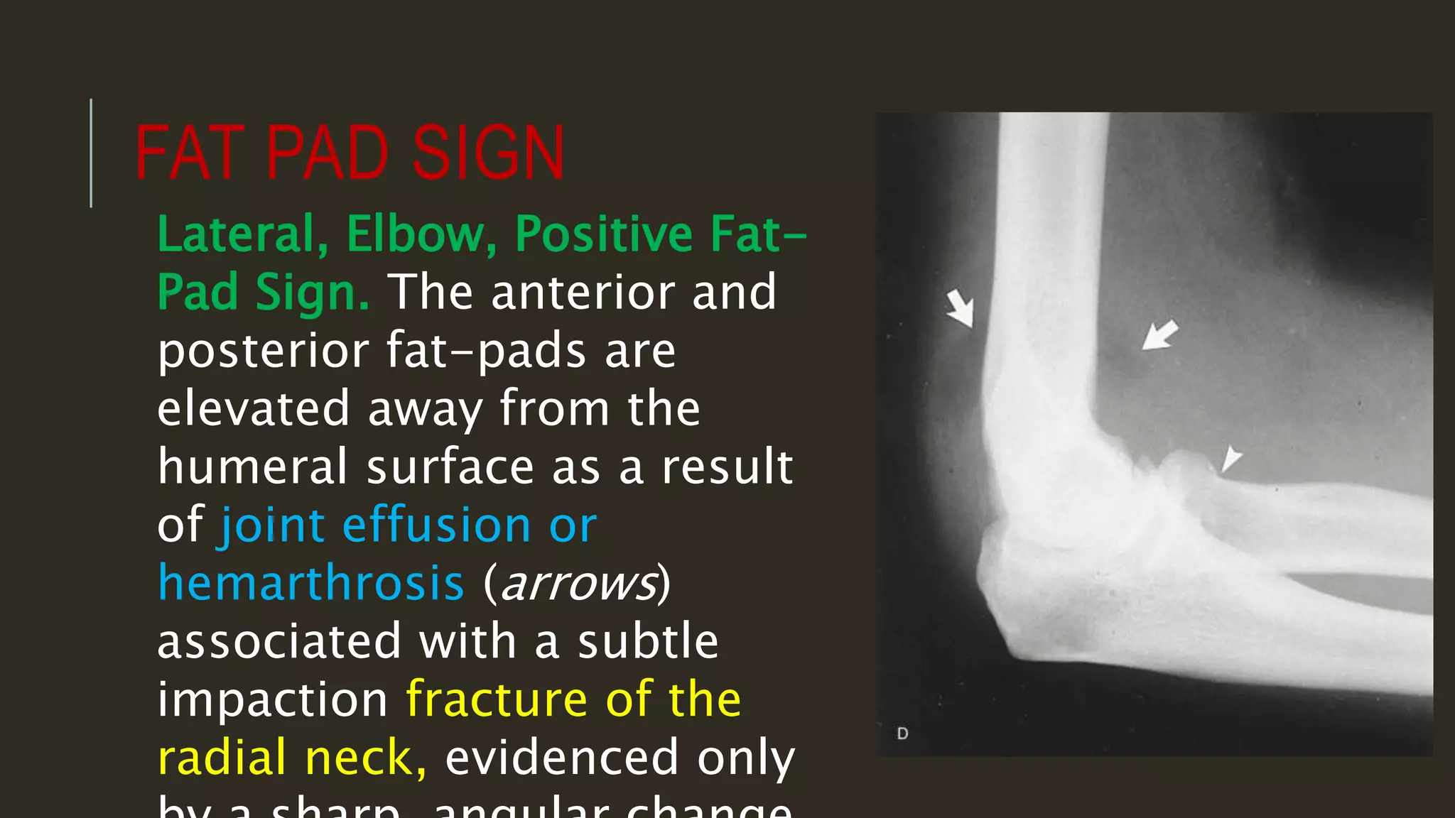X ray of elbow joint | PPTX