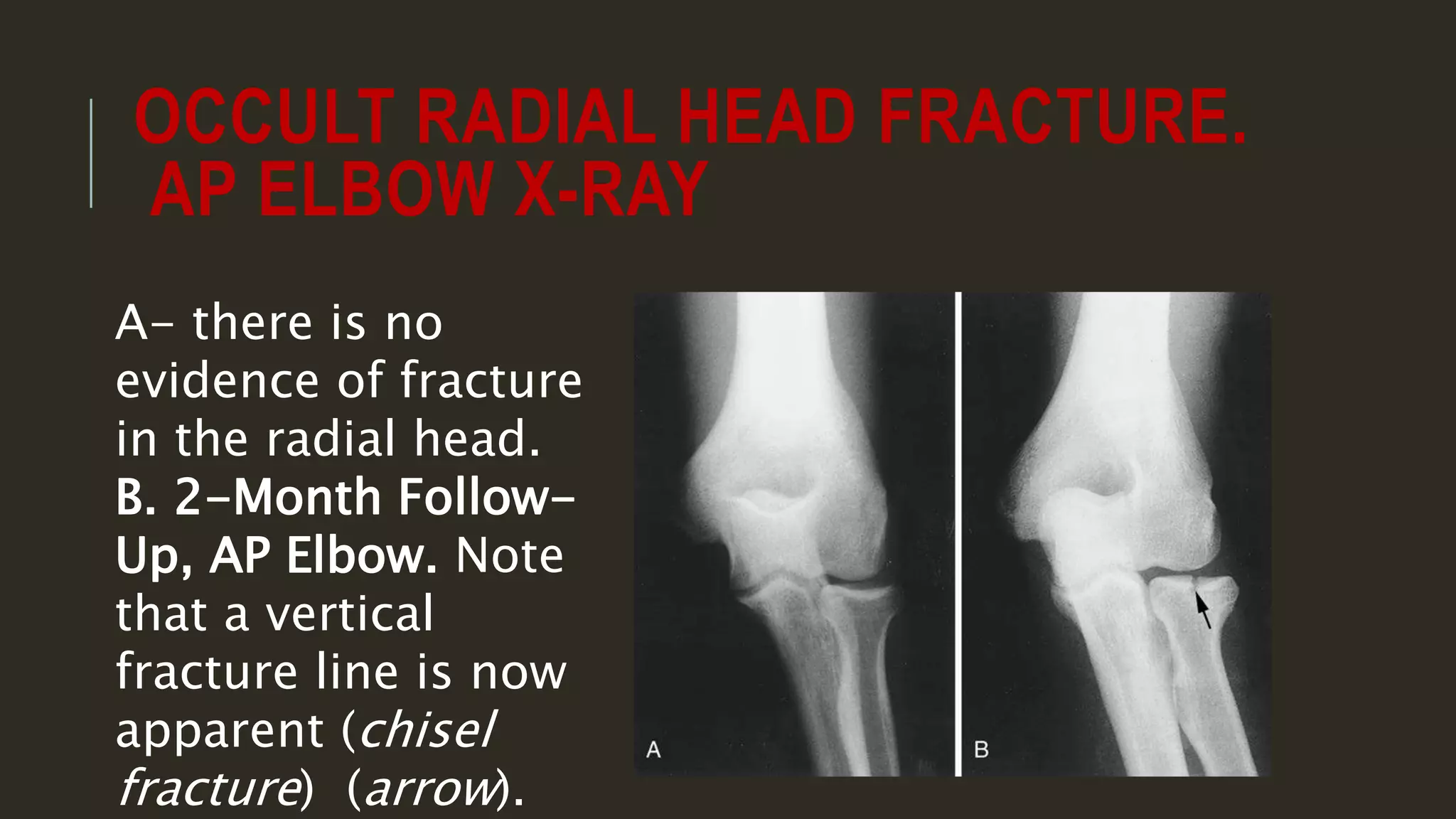 X ray of elbow joint | PPTX