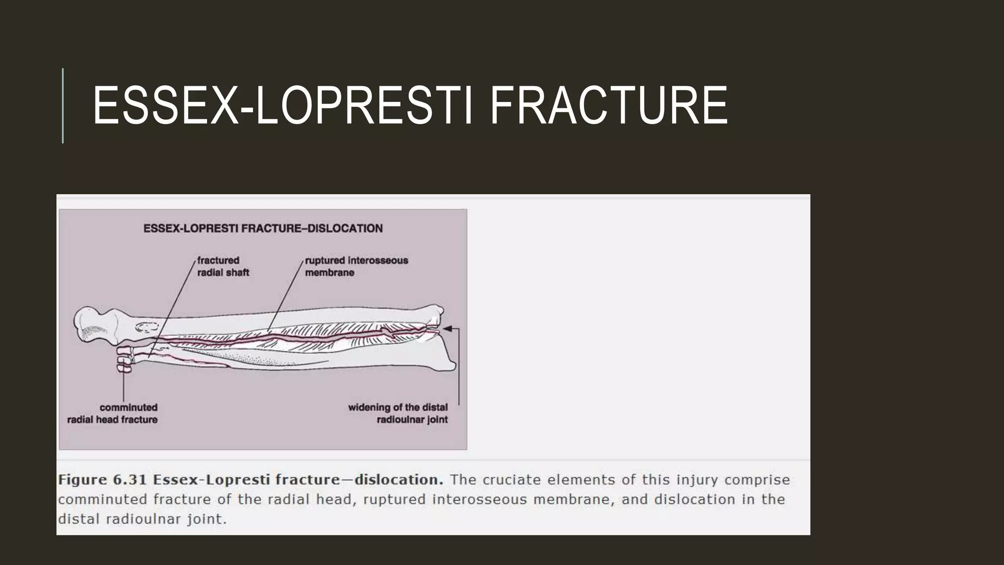 X ray of elbow joint | PPTX | Death, Injury, or Military Conflict ...