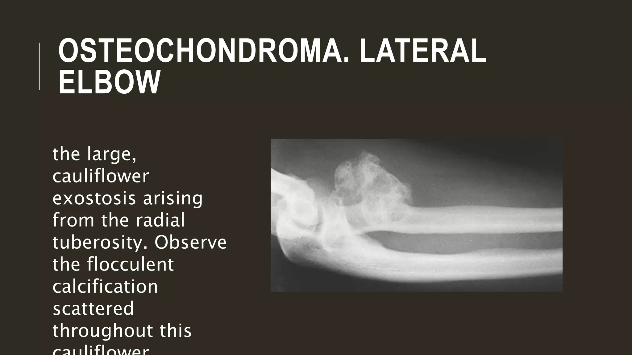 X ray of elbow joint | PPTX