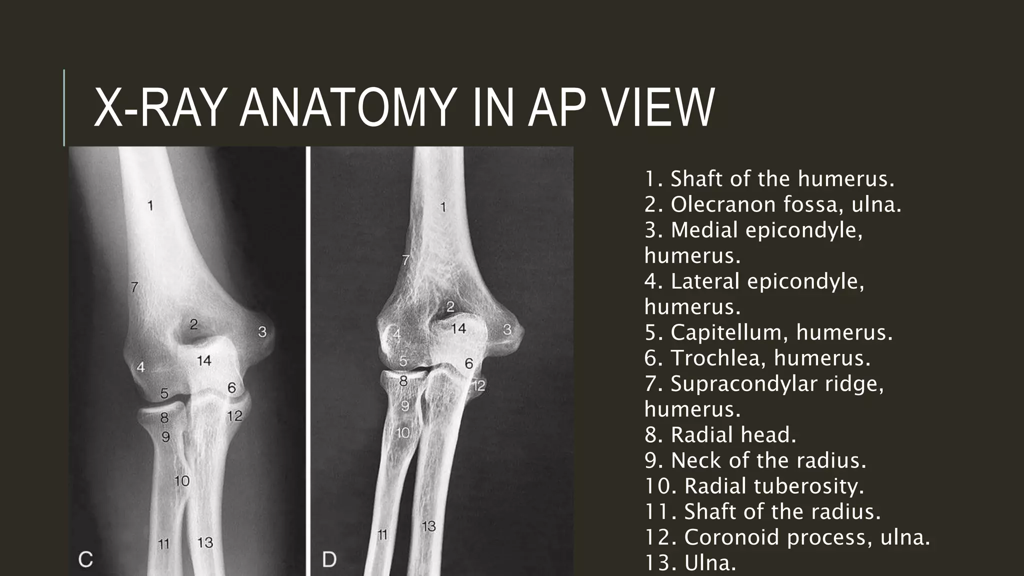 X ray of elbow joint | PPTX | Death, Injury, or Military Conflict ...