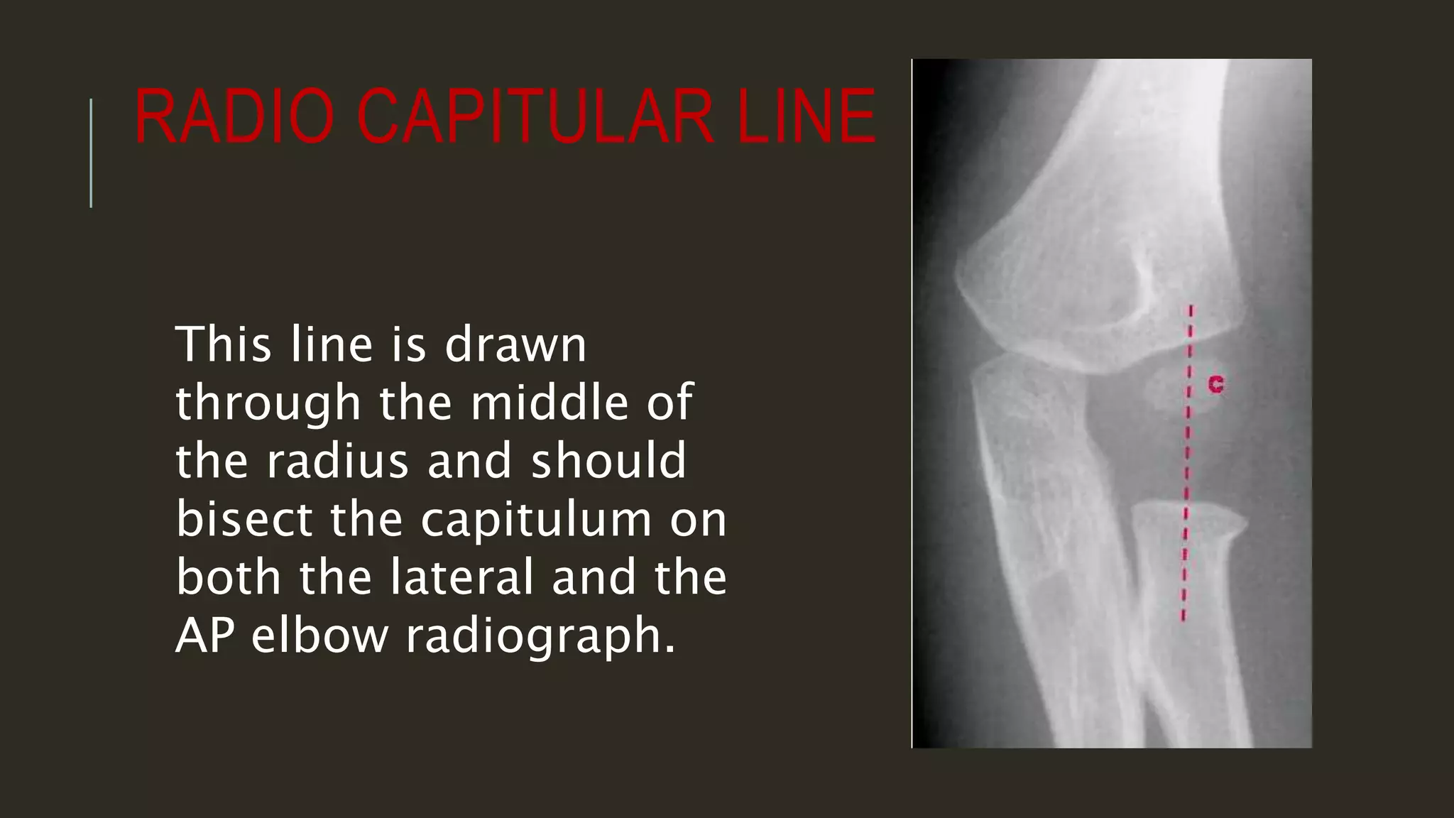 X ray of elbow joint | PPTX