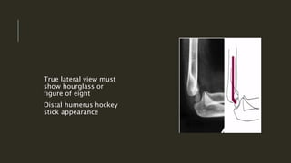 X ray of elbow joint | PPTX
