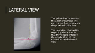 X ray of elbow joint | PPTX