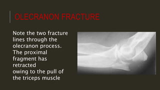 X ray of elbow joint | PPTX