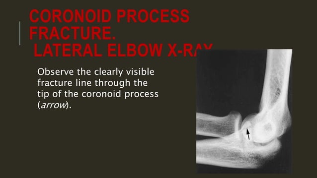 X ray of elbow joint | PPTX | Death, Injury, or Military Conflict ...