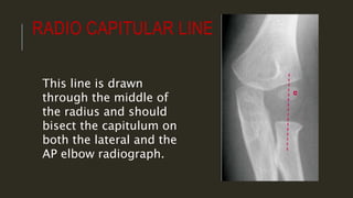 X ray of elbow joint | PPTX