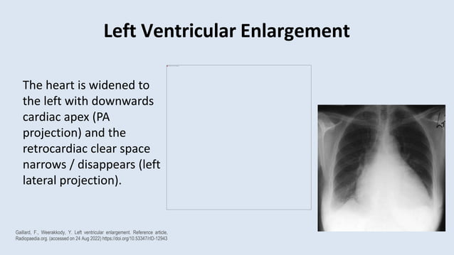 X-RAY OF THE HEART.pptx