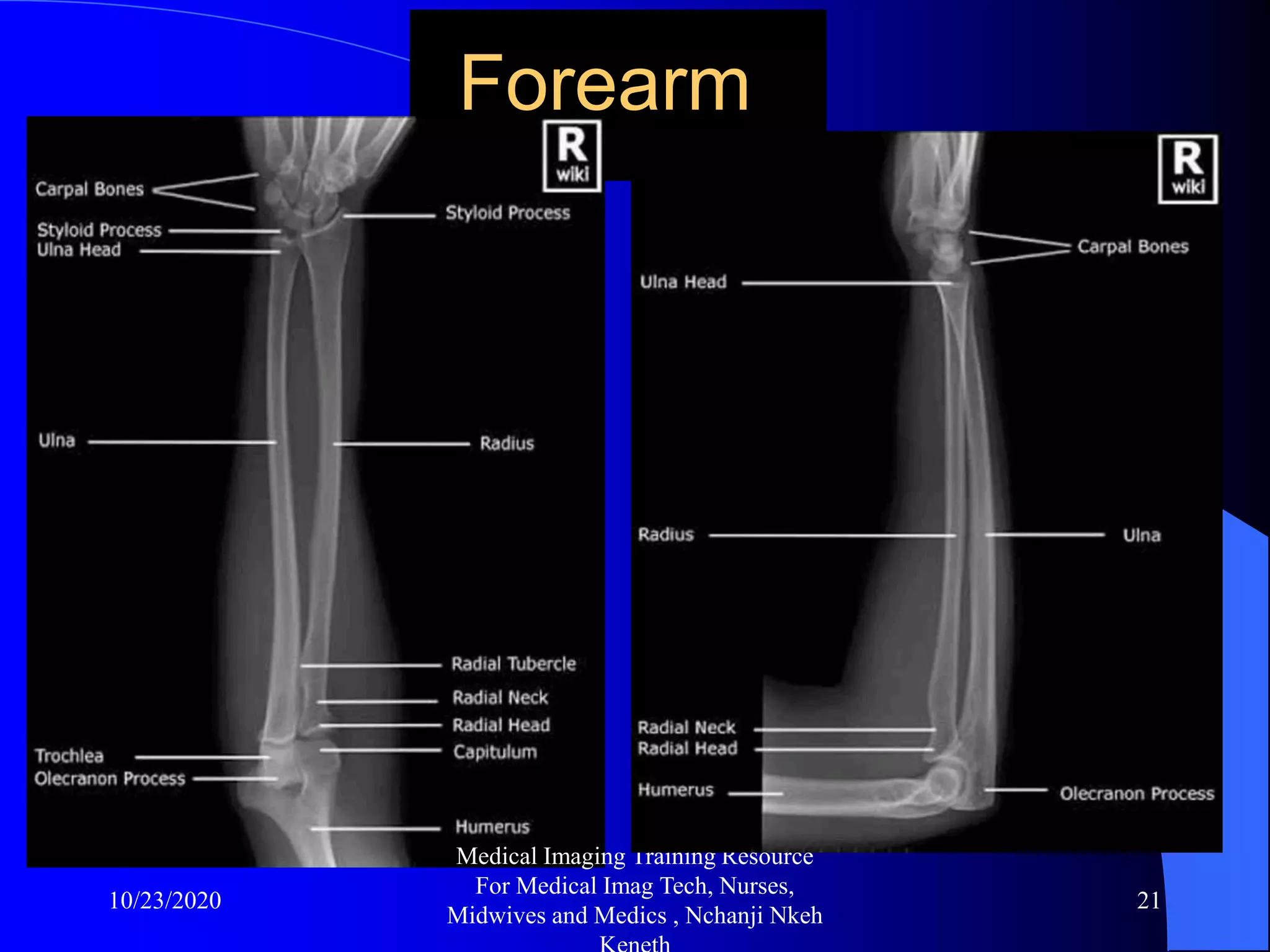 X ray of the upper limbs radiology raining resource nchanji nkeh keneth ...