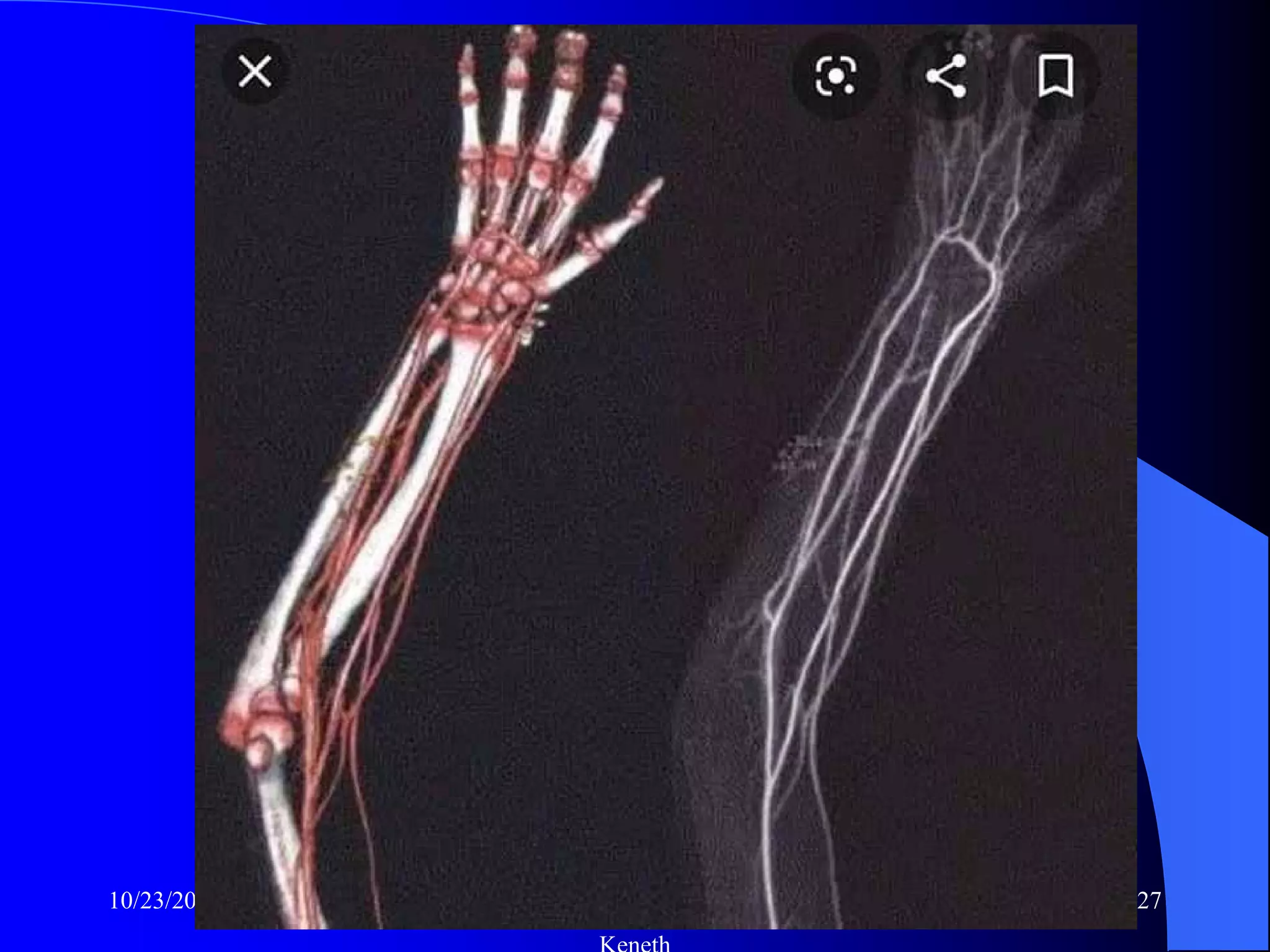 X ray of the upper limbs radiology raining resource nchanji nkeh keneth ...