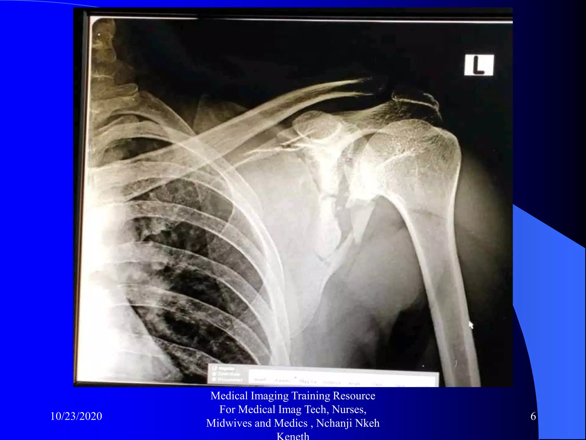 X ray of the upper limbs radiology raining resource nchanji nkeh keneth ...