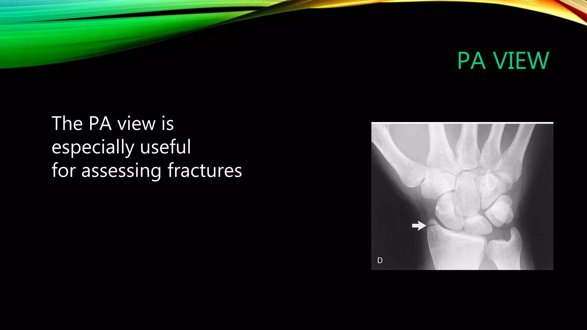 X ray of wrist and hand | PPTX