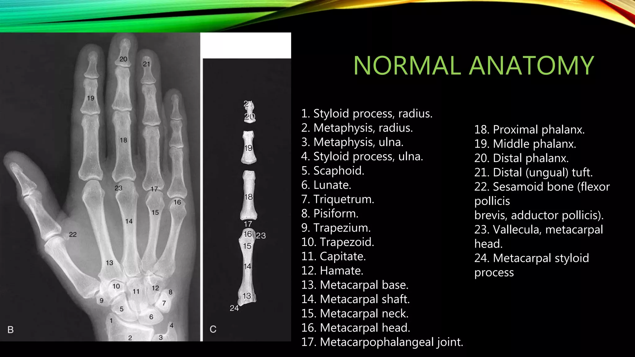 X ray of wrist and hand | PPTX