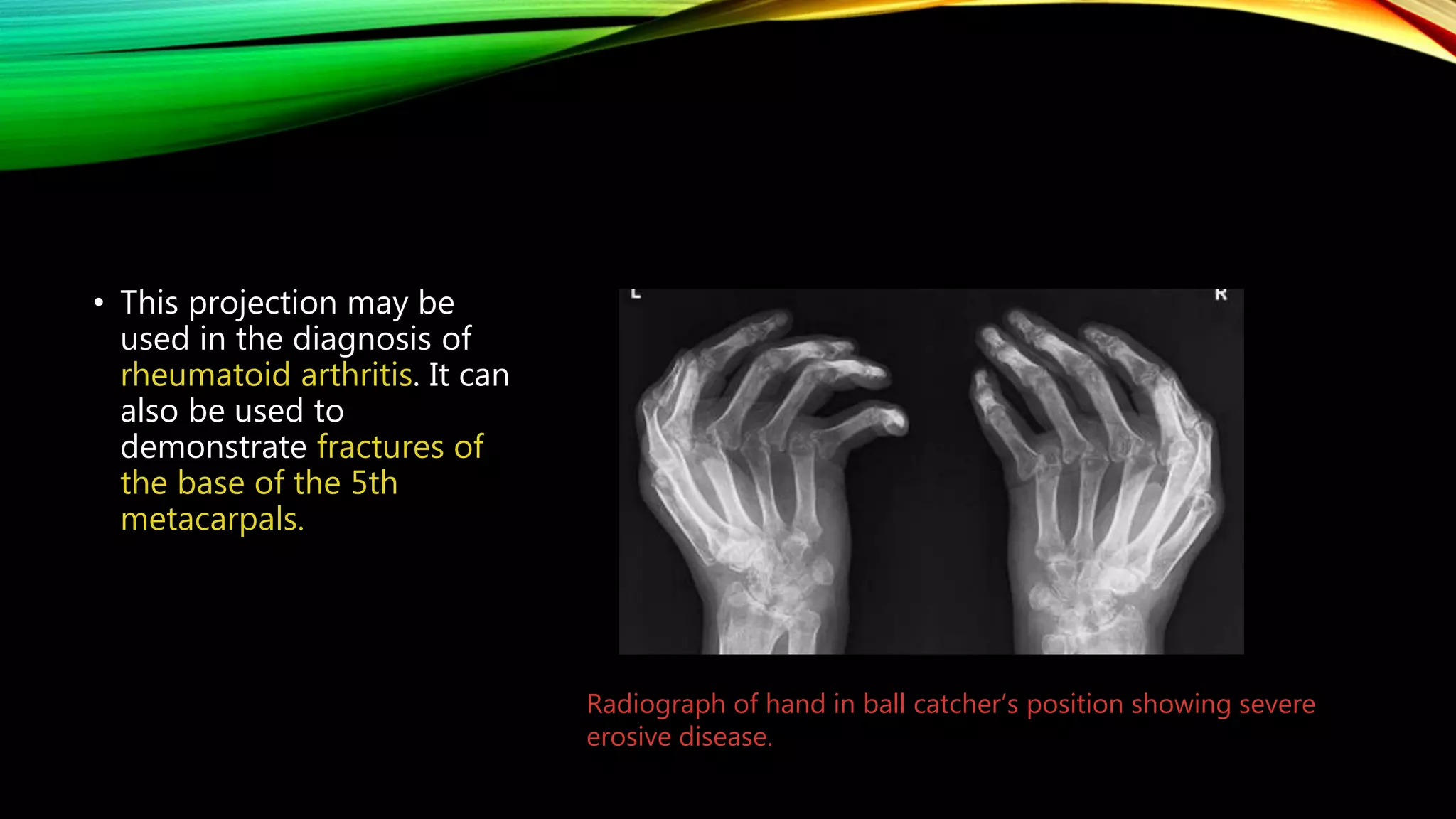 X ray of wrist and hand | PPTX