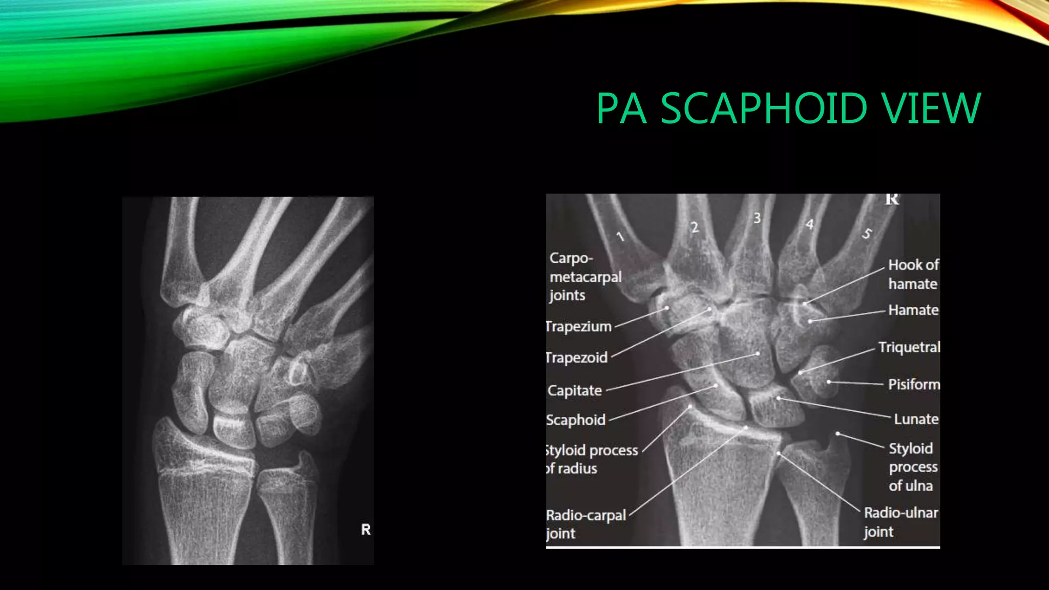 X ray of wrist and hand | PPTX