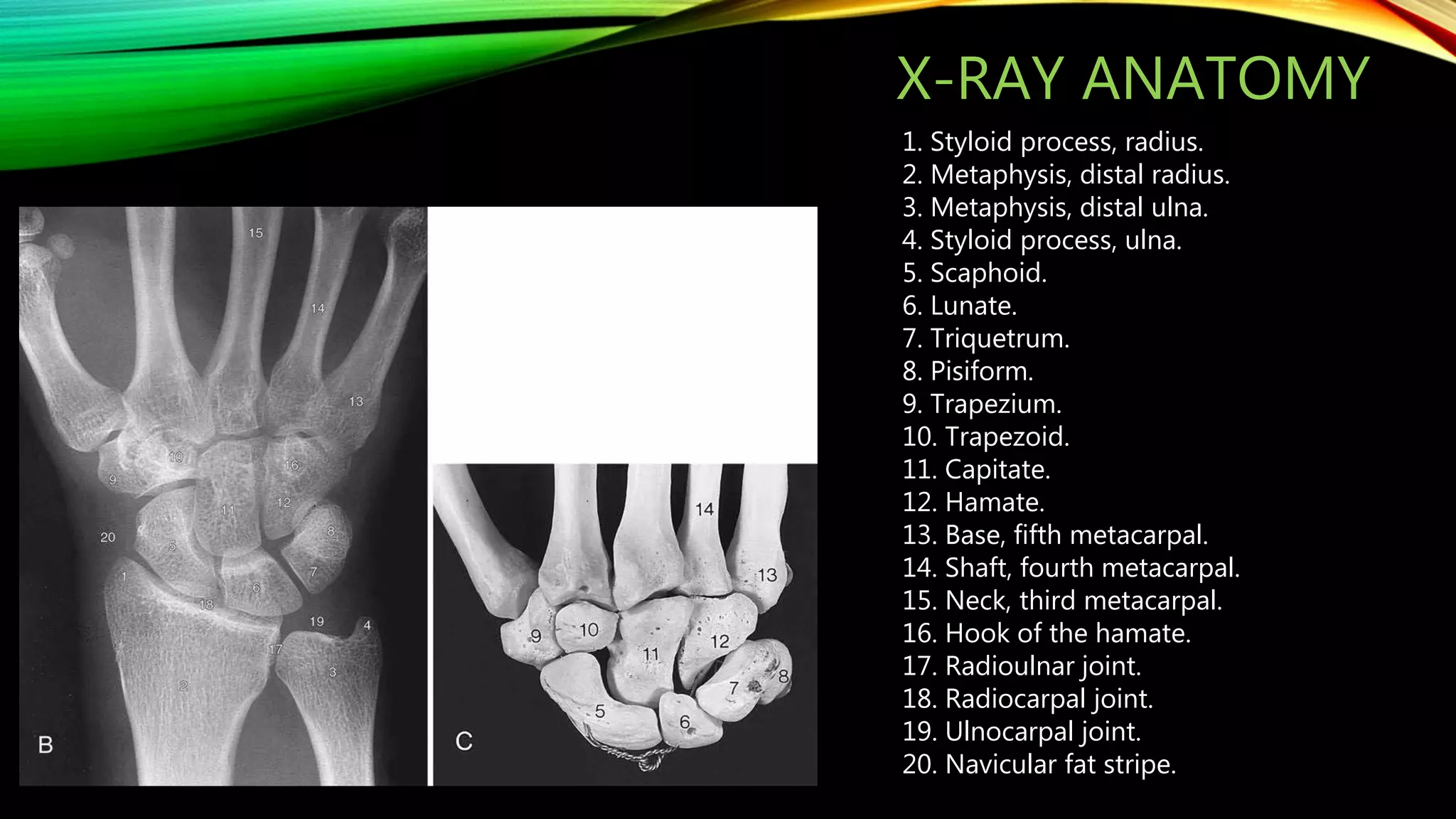 X ray of wrist and hand | PPTX
