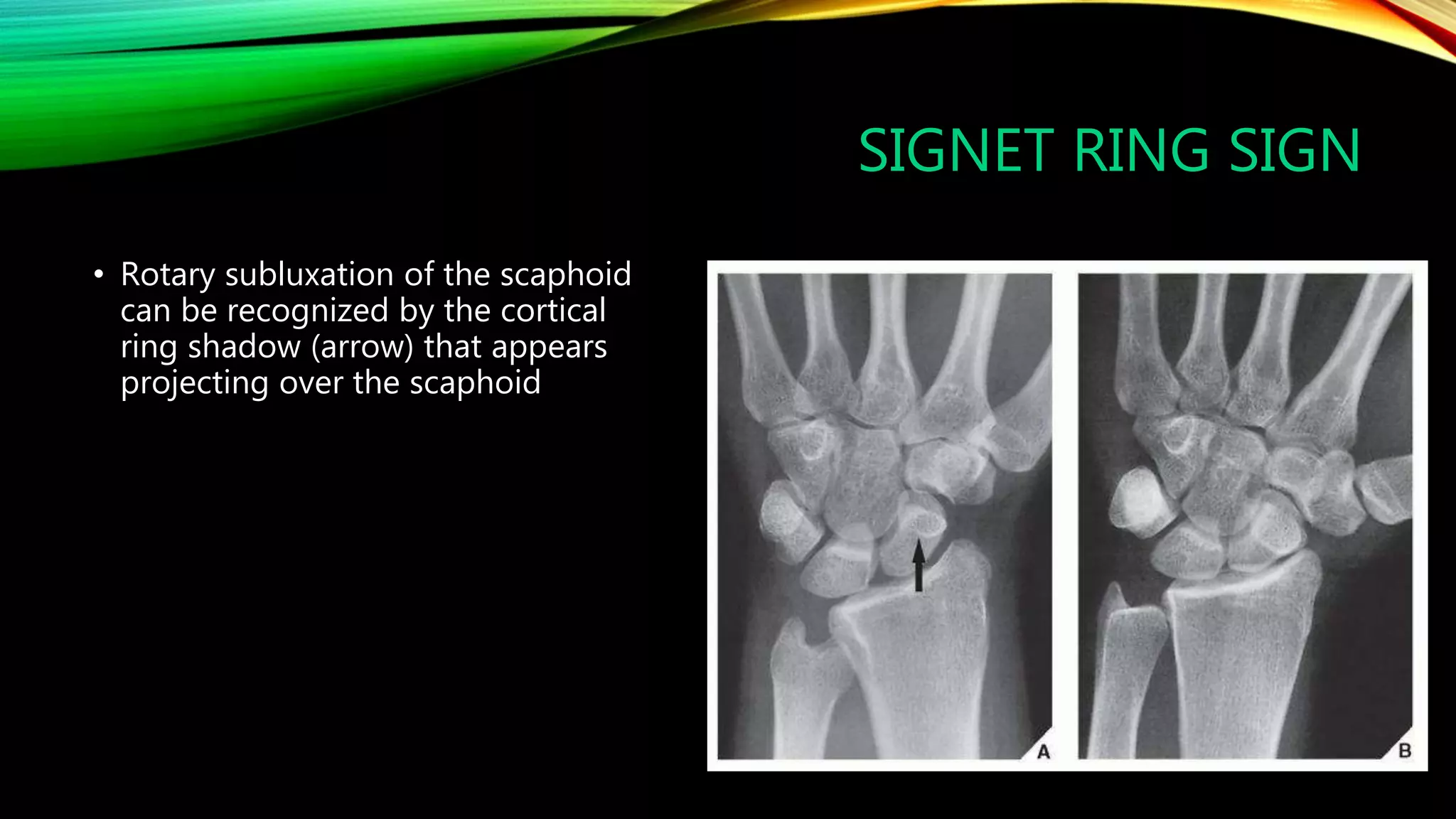 X ray of wrist and hand | PPTX