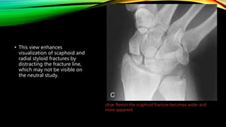 X ray of wrist and hand | PPTX