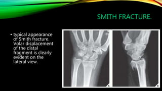 X ray of wrist and hand | PPTX