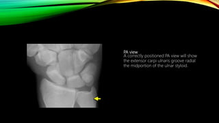 X ray of wrist and hand | PPTX