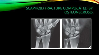 X ray of wrist and hand | PPTX