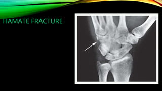 X ray of wrist and hand | PPTX